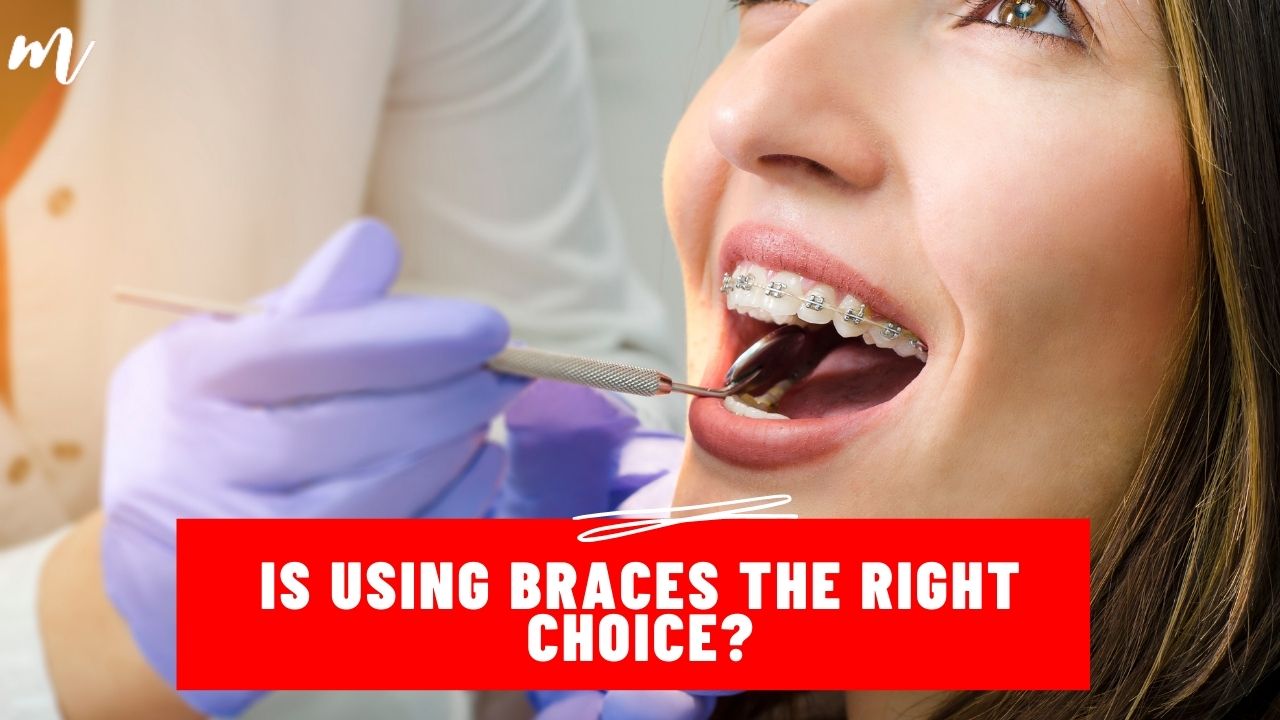 How Do Braces Work Types Cost And Side Effects